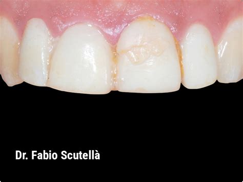 Corso Restaurativa Indiretta Scutellà Ferraris Komet