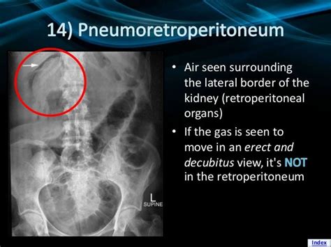Signs Of Pneumoperitoneum On Plain Film