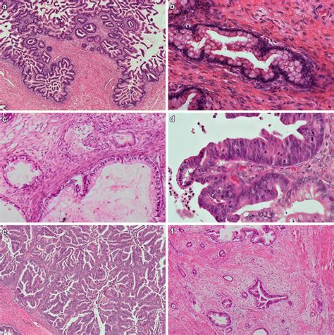 Mbt Showing Cystic Glandular Structures With Papillary Infoldings