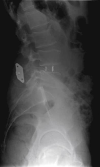 Spinous Process Plates For Lumbar Fixation Neupsy Key