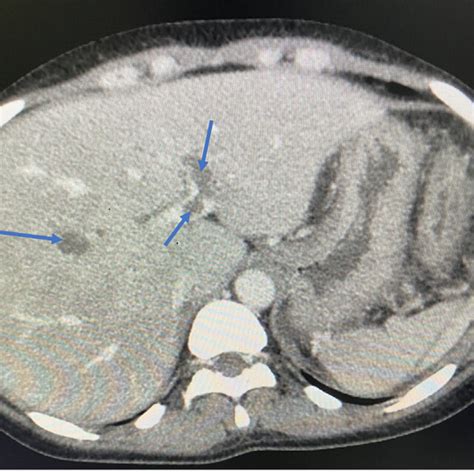 Axial Section Of An Injected Abdominal Ct Scan Showing Septic