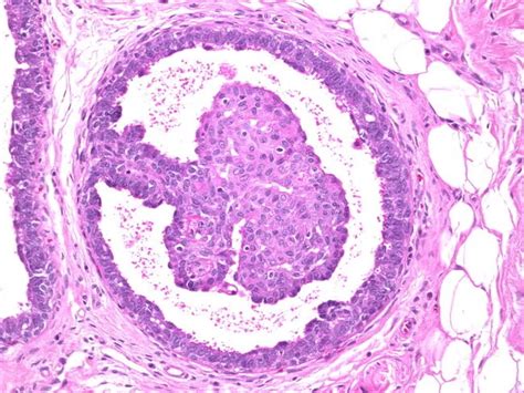 Benign Breast Disease — Creogs Over Coffee
