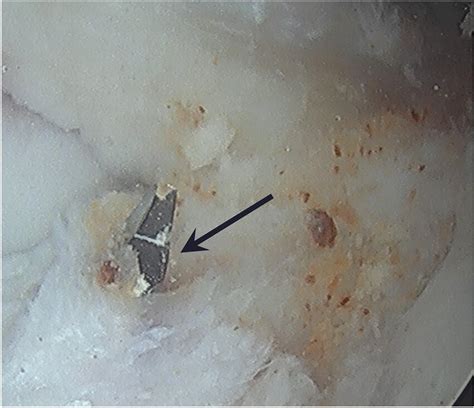 Tibial Tunnel Placement Left Knee Shown Existing The Centre Of The