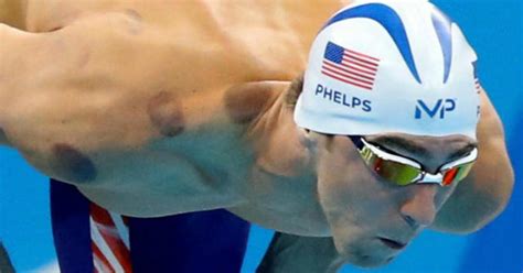 Why Olympians Are Doing The Cupping Treatment Cbs News