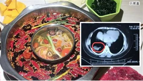 男子咳足2年照ct有陰影以為肺癌 手術發現竟是「打邊爐」導致