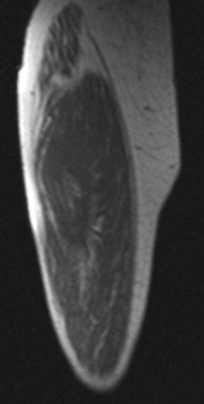 Proliferative Myositis Applied Radiology