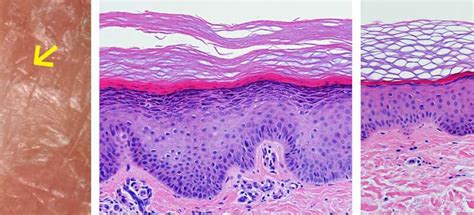 Natural Gene Therapy For Intractable Skin Disease Discovered