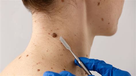 Skin Cancer Types Signs And Risk Factors