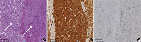 肾神经鞘瘤二例报告并文献复习
