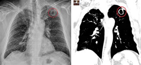 「長新冠」藏陷阱！久咳不癒當心，男咳到肺破洞竟是這病引起 健康遠見