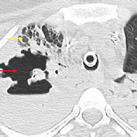 Verticalization Therapy For ARDS Patients Receiving VV ECMO Critical Care News News For