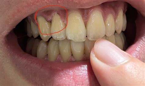 치아와 잇몸 사이 검은색 뭔가요 지식in