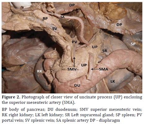 Histomorphological Study Of Unusual And Extensive Uncinate Proces