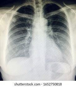 Nsclc Images Stock Photos And Vectors Shutterstock