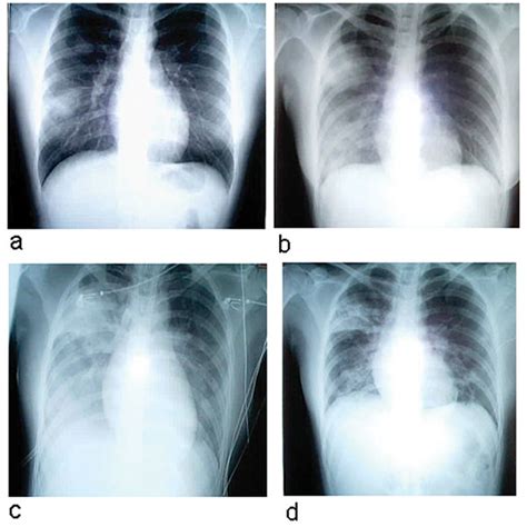 Severe Acute Respiratory Syndrome Respiratory Syndrome Severe Acute