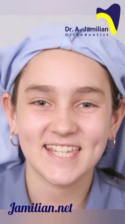 Non Surgical Treatment Of Maxillary Deficiency In Adult Abdolreza