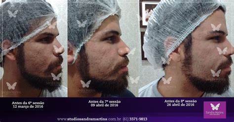 Resultados Reais De Microagulhamento Cicatriz Acne Brasilia 5 Sandra