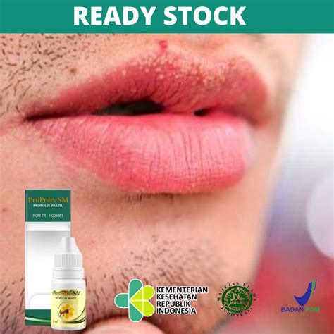Jual Obat Penghilang Bintik Putih Di Bibir Obat Bercak Putih Di Sekitar Bibir Bibir Bintik