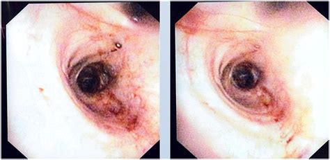 Bronchoscopy Revealed An Area Of Possible Bleeding Download Scientific Diagram