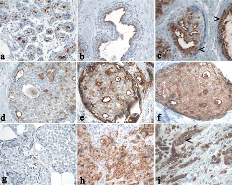 Comparison Of Muc1cd227 Immuno Staining Patterns Muc1ma695