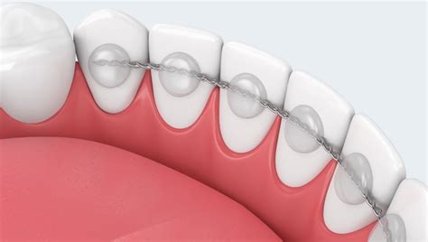 3 Types Of Dental Retainers Hawley Clear And Fixed Retainers