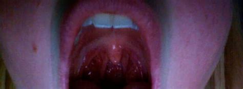 Chlamydia In Throat Pictures Symptoms Diagnosis Std Testing Near Me