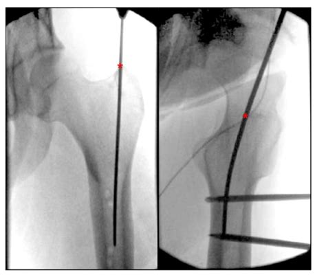 Femoral Intramedullary Nailing How To Choose The Best Insertion Point