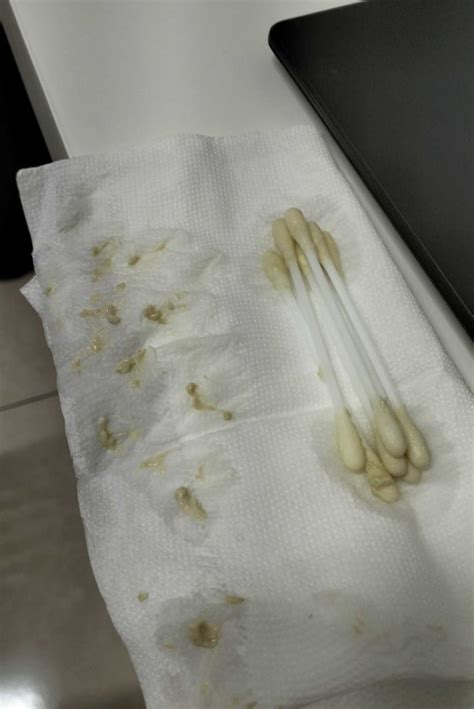求救！陰道可能念珠菌感染？ 女孩板 Dcard