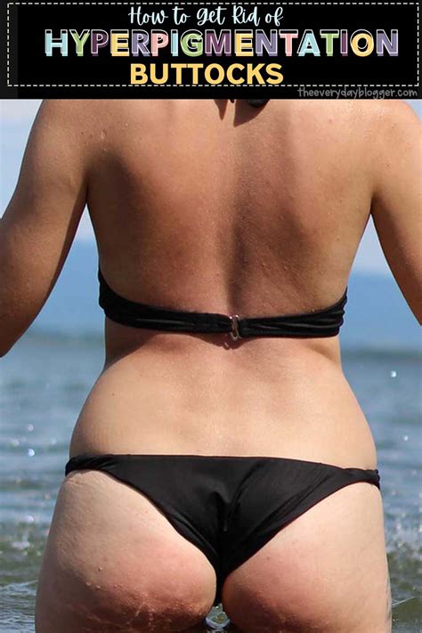 How To Get Rid Of Hyperpigmentation On Buttocks The Everyday Blogger