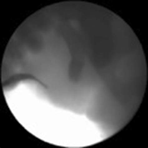 Urethrogram Showing Long Gap In Re Redo Urethroplasty Bulbar Urethral Download Scientific
