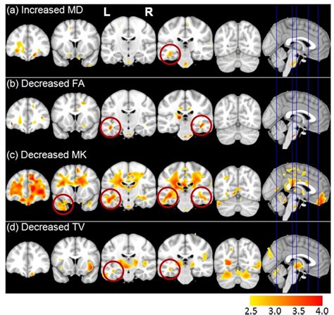 Diffusional Kurtosis Imaging Reveals Widespread Structural Abnormalities In Medial Temporal Lobe
