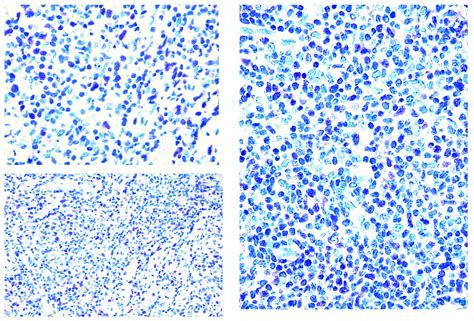 Paradigmatic Example Of Score 2 Of Tox Expression In Different Cases
