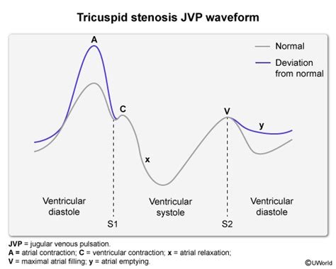 Valve Disorders Tricuspid Stenosis Cardiology Uworld Medical Library
