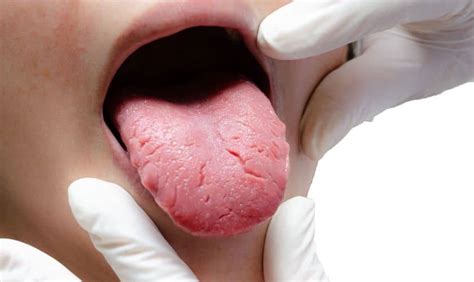Angry Mouth Syndrome