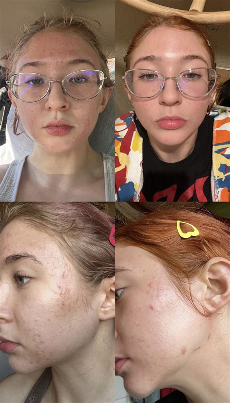 Before And After I Stopped Using Tretinoin Back On It Again 3 Dont