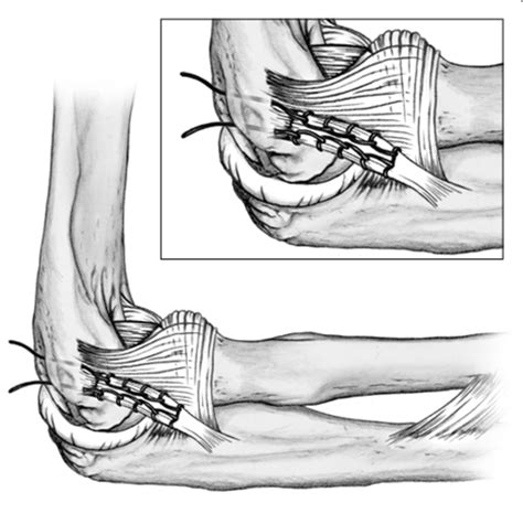 Shoulder And Elbow Surgery Terrible Triad Injury The Importance Of