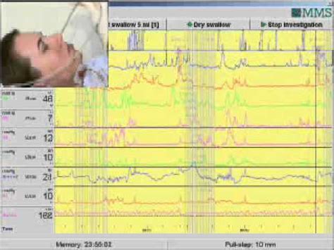 Video 1 Performing Esophageal Manometry YouTube
