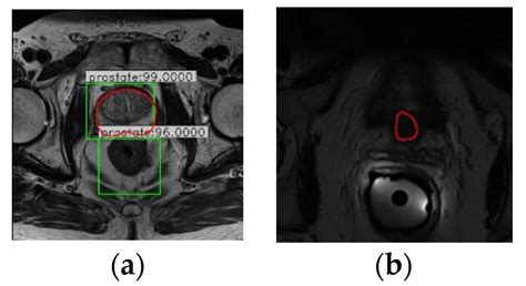 cda net for automatic prostate segmentation in mr images