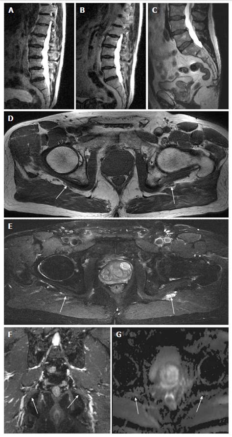 Lumbar Plexus Mri Protocol