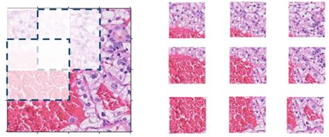 Tiling Extracting Overlapping Patches Of Training Subjects Wsis