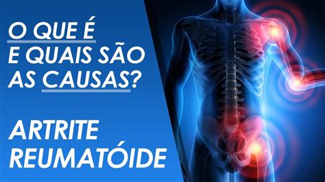 Artrite Reumat 243 Ide Sintomas Causas E Tratamento Augusto Bene Riset