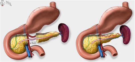 An end-to-end pancreatic anastomosis in robotic central pancreatectomy ...