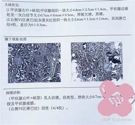 28岁 甲状腺癌 患病心路历程半切术后感受 知乎