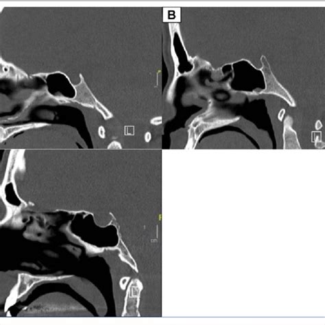 The Sinus Pneumatization Pattern Was Classified As Conchal Presellar