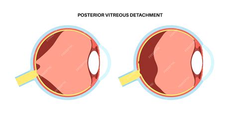 Premium Vector Posterior Vitreous Detachment