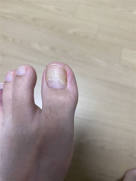 발톱에 가로줄 생겼는데 이거 뭐야 인스티즈instiz 일상 카테고리