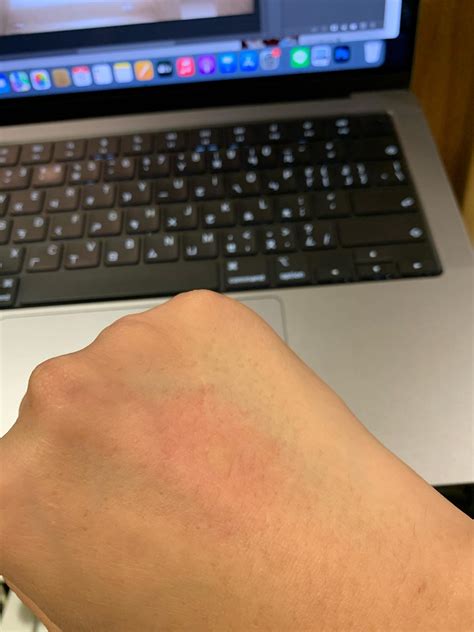 有沒有人跟我一樣以前完全不會尋麻疹，但很剛好打完疫苗後就開始頻繁發作（中醫跟我說有可能疫苗引發的體質轉變，會持續一生）。 這輩子逃不了。