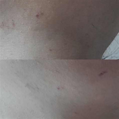 피부에 목에 붉은점들 지식in