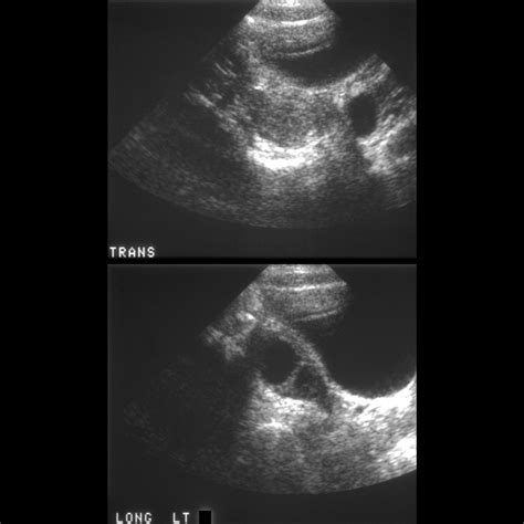 Pediatric Ovarian Cyst Pediatric Radiology Reference Article