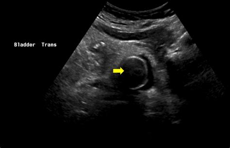 Pocus Gallery Renal Fellow Network
